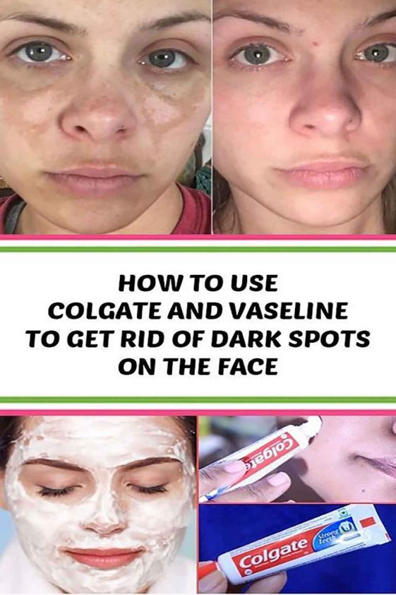 HOW TO USE COLGATE AND VASELINE TO GET RID OF DARK SPOTS ON THE FACE ...