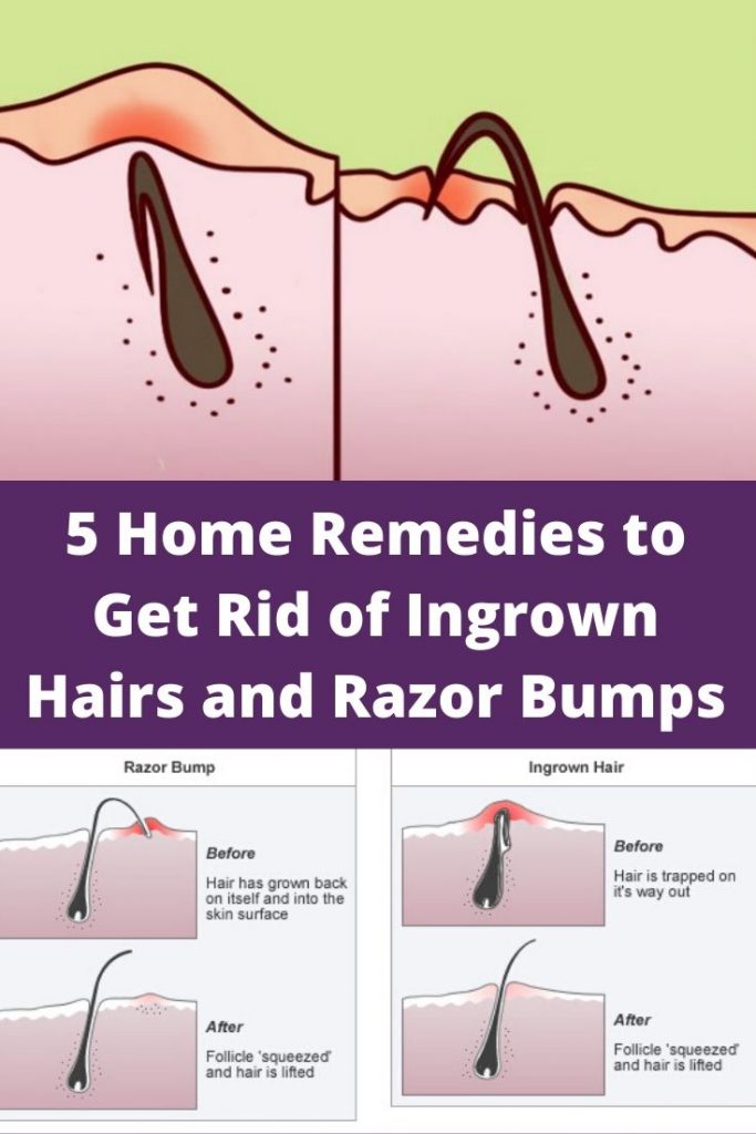 5 HOME REMEDIES TO GET RID OF INGROWN HAIRS AND RAZOR BUMPS – Yoga4daily