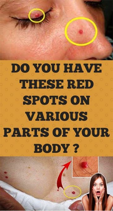 DO YOU HAVE THESE RED SPOTS ON VARIOUS PARTS OF YOUR BODY? – Yoga4daily