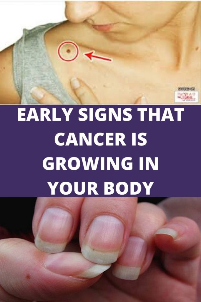 EARLY SIGNS THAT CANCER IS GROWING IN YOUR BODY – Yoga4daily