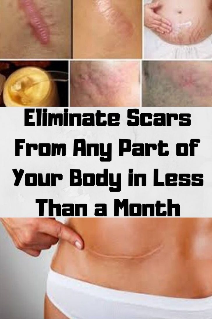 ELIMINATE SCARS FROM ANY PART OF YOUR BODY IN LESS THAN A MONTH ...