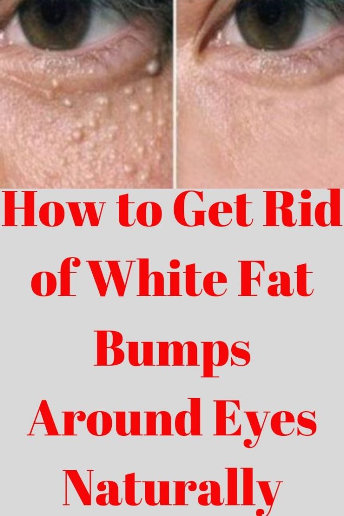 HOW TO GET RID OF WHITE FAT BUMPS AROUND EYES NATURALLY – Yoga4daily