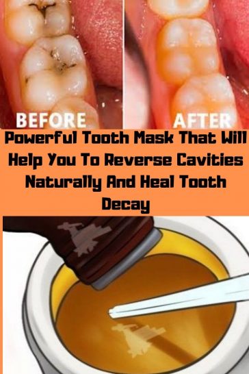 Powerful Tooth Mask That Will Help You To Reverse Cavities Naturally ...