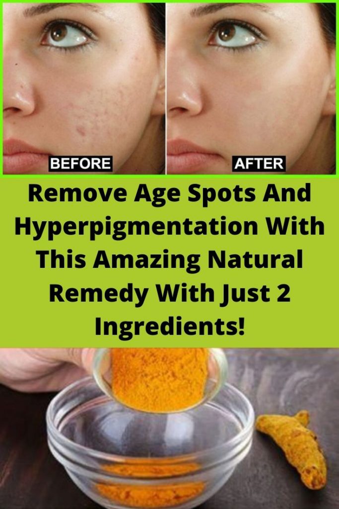 Remove Age Spots And Hyperpigmentation With This Amazing Natural Remedy ...
