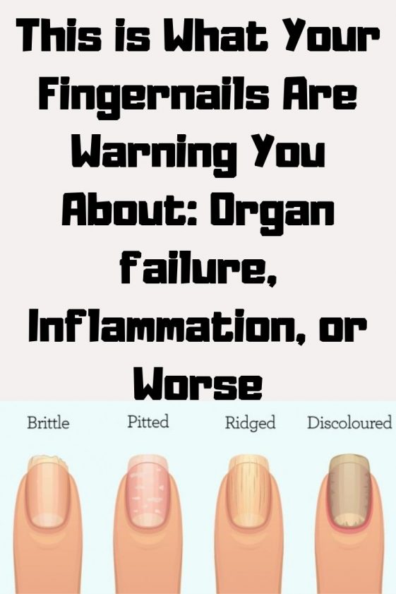 THIS IS WHAT YOUR FINGERNAILS ARE WARNING YOU ABOUT: ORGAN FAILURE ...