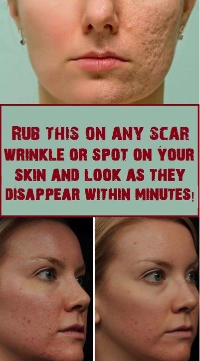 RUB THIS ON ANY SCAR, WRINKLE OR STAIN YOU HAVE ON YOUR SKIN AND ENJOY ...